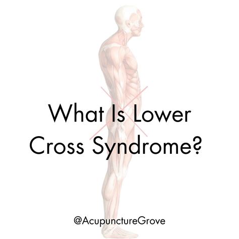 Acupuncture For Lower Cross Syndrome Acupuncture Grove