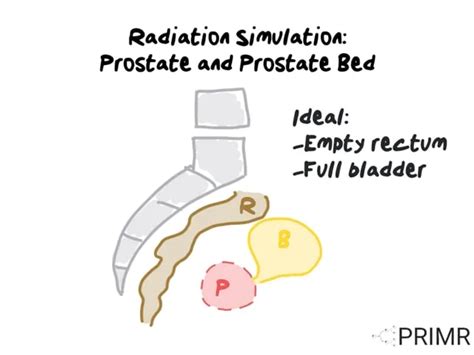 Primr Prostate Cancer Radiation Simulation Procedure Patient Instructions