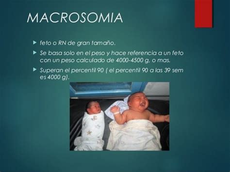 Macrosomia