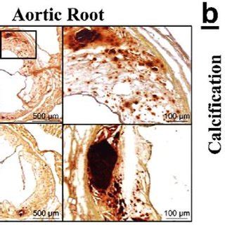 DCA Induced P MAPK Activation Promotes VSMC Calcification Via Runx Download Scientific