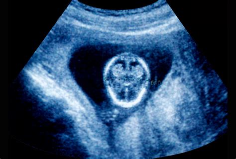 New Findings On Phelan Mcdermid Syndrome And More The Transmitter Neuroscience News And