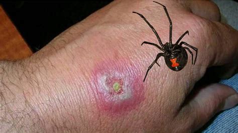 Black Widow Spider Bites