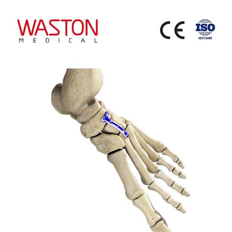 Implants Osteotomy Ce The Second Metatarsal Cuneiform Joint Dorsal Plate 10808 Waston China