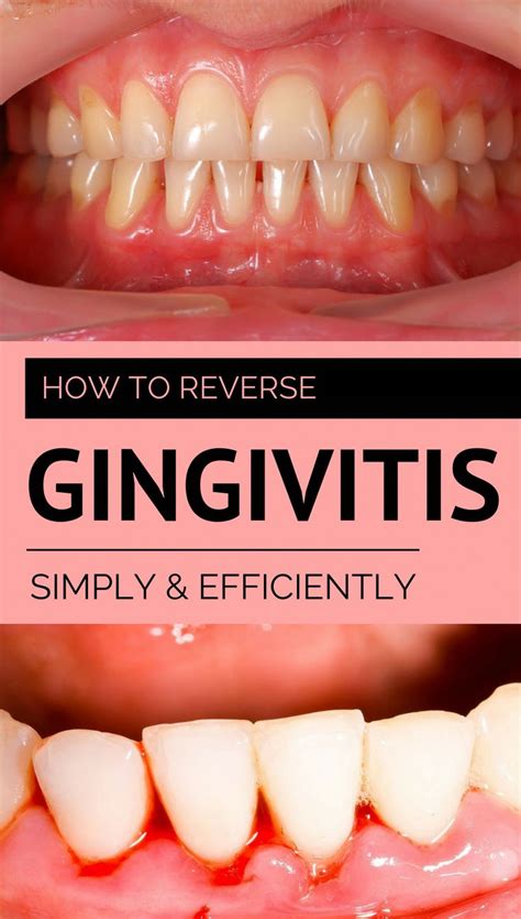 Why Wont My Gingivitis Go Away At Matthew Blackburn Blog
