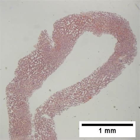 Congestive Hepatopathy Libre Pathology