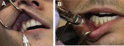 Lip Augmentation Oral And Maxillofacial Surgery Clinics