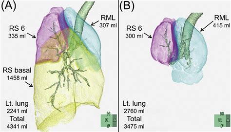 Thoracoscopic Right Basilar Segmentectomy After Right Upper Lobectomy The Annals Of Thoracic