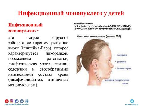 Инфекционный мононуклеоз у детей презентация онлайн
