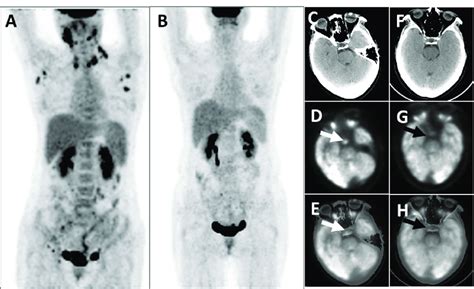 This Patient With Lch Developed Multiple Hypermetabolic Lymph Nodes
