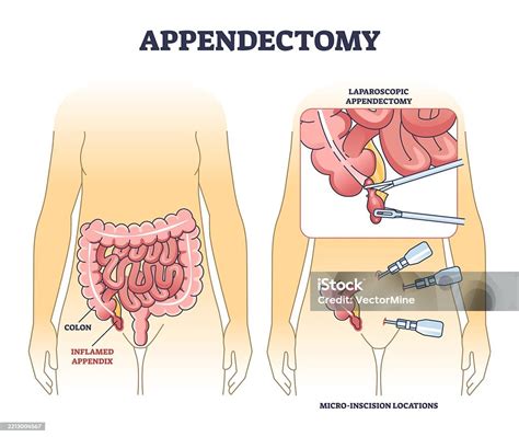 Appendectomy Diagram Shows The Inflamed Appendix Colon And Laparoscopic
