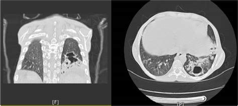 Chest High Resolution Ct Displayed A Large Area Of Cystic Download Scientific Diagram