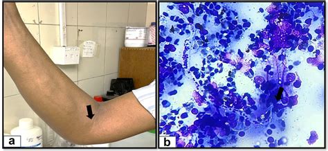 Illuminating The Cytological Intricacies Of Isolated Filarial