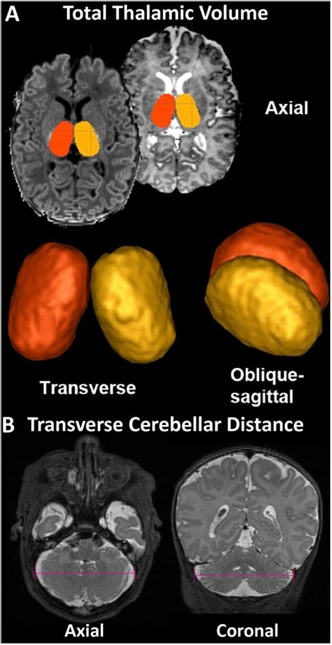 Subcortical Morphology Measurement Methodology A Quantitation Of Download Scientific Diagram