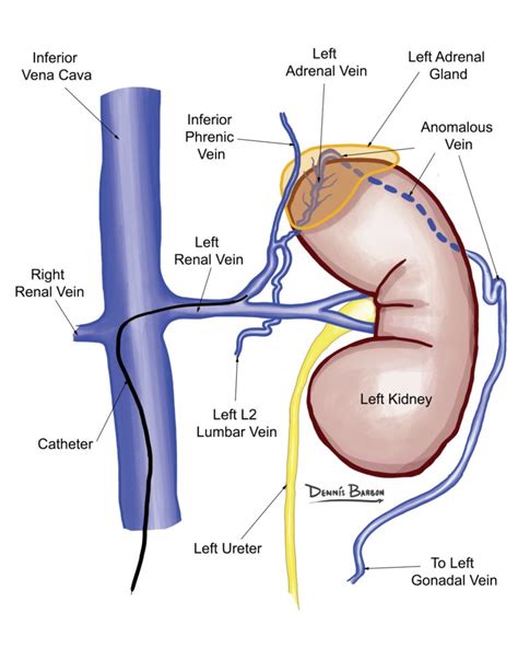 Anomalous Adrenal Vein Anatomy Dennis Barbon