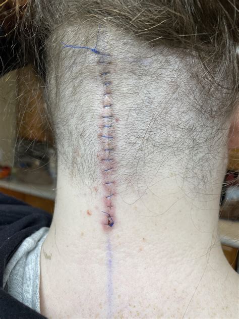 Arnold Chiari Malformation Scar