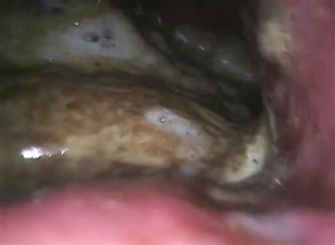 Belly After Coke And Mentos Thisvid Com