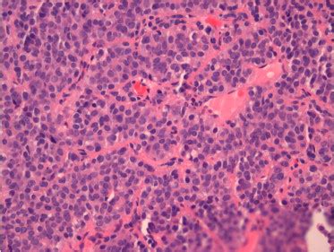 Primary Ewings Sarcoma Of The Ethmoid Sinus With Intracranial And Orbital Extension Case