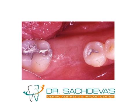 Socket Preservation Ridge Preservation Pptx Dental Health