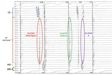 Electrogram Interpretation 19 Ep Essentials