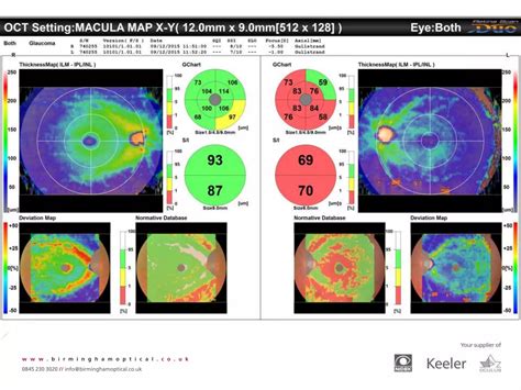 Glaucoma And Oct Are Macula Scans More Valuable Than Disc Scans Pptx