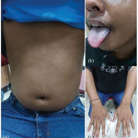 Sle Diagnostic Criteria According To 2019 Acreular 8 Download