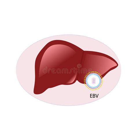 Symptoms Of Infectious Mononucleosis Disease Stock Vector