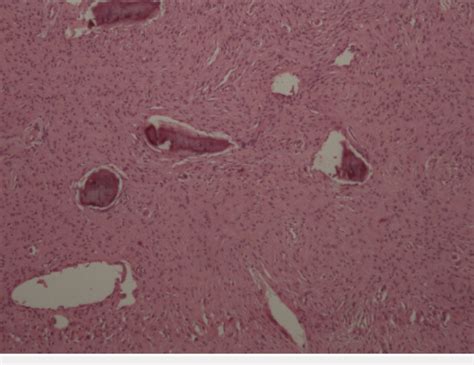 Histological Image Of Osteosarcoma Nests Of Tumor Cells Having