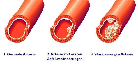 Medizin Bahnbrechende Erkenntnisse Zur Arteriosklerose Welt