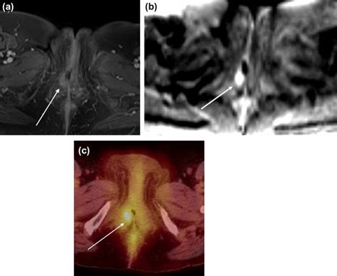 Gynecologic Tumor Board A Radiologists Guide To Vulvar And Vaginal Malignancies PMC