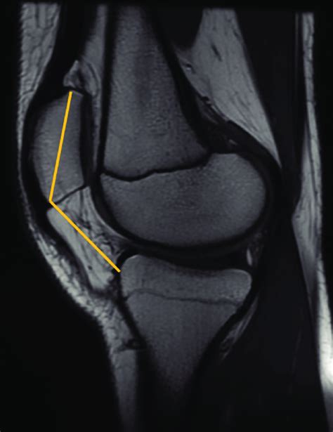 Insallsalvati Indices From Patellar Bone Length And Patellar Tendon