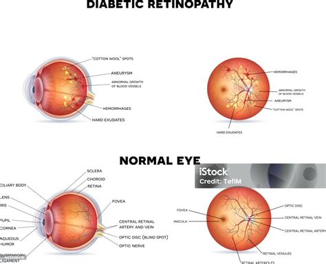 Retinopati Diabetes Ilustrasi Stok Unduh Gambar Sekarang Retinopati