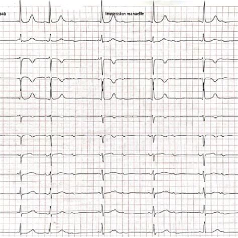 Dislodgement Of The Right Atrial And Ventricular Lead Both Leads Were Download Scientific