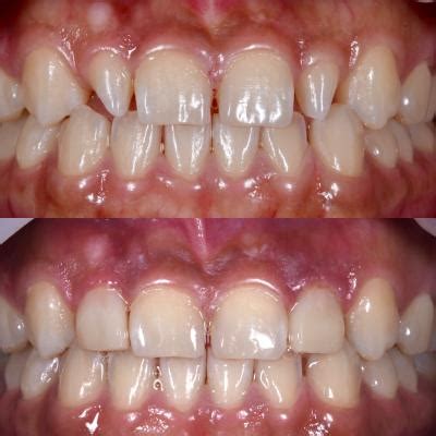 What Is Enameloplasty When And How To Perform This Procedure