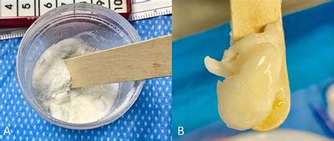Creation Of Vancomycin Paste A Appearance Of Vancomycin Powder Prior To Download Scientific
