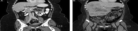 A Novel Nipbl Nacc1 Gene Fusion Is Characteristic Of The Cho The
