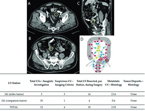 Case No 5 Two Synchronous Sigmoid Tumors Parietal Thickening Of The Download Scientific