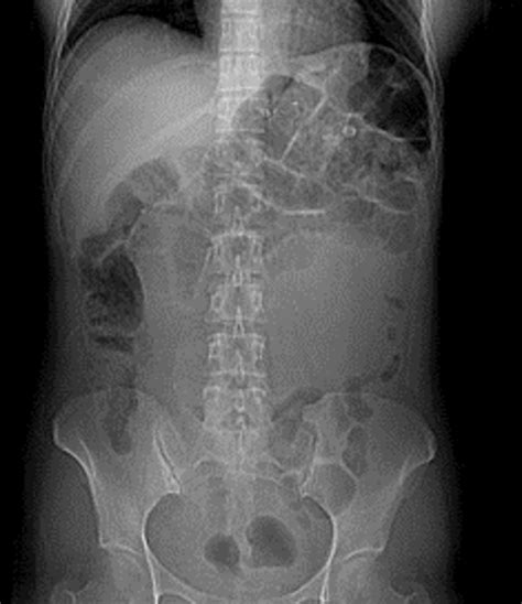 Target Sign Intussusception X Ray The Appearance Is Generated By Concentric