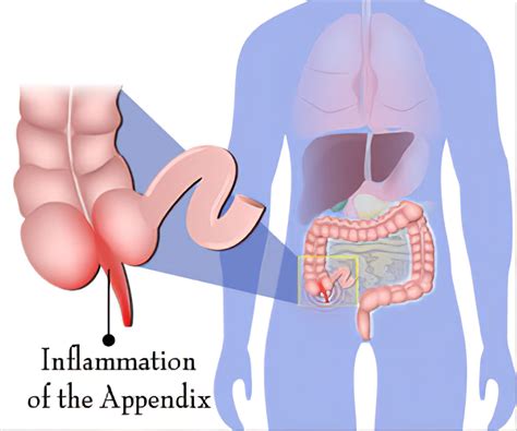 How To Detect Appendicitis Corestep