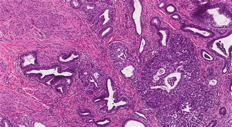 Adenocarcinoma In Situ Of The Cervix Ottawa Atlas Of Pathology