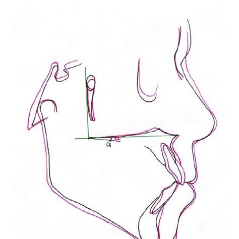 superimposition black cephalometric tracing 1 and c1 centroid