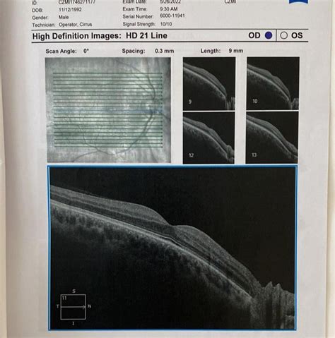 31 M Lattice Degeneration Management Rophthalmology