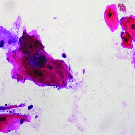 Photomicrograph Showing Papanicolaou Stained Class Iii Cytology