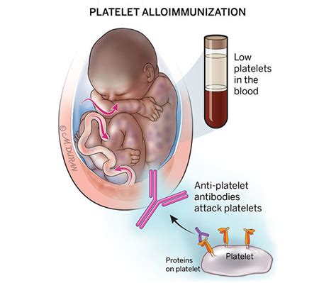 Platelet Alloimmunization Partners In Care