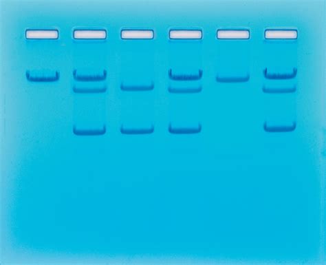 sickle cell gene detection dna based biotek