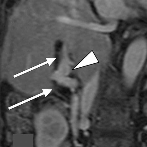 Biliary Abnormalities Associated With Portal Biliopathy Evaluation On