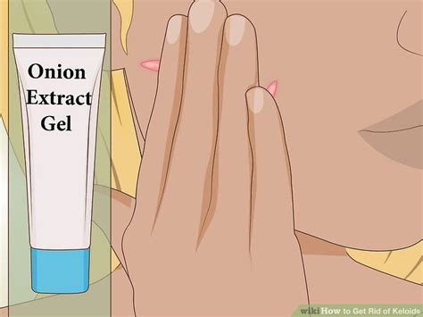 Ways To Get Rid Of Keloids Artofit