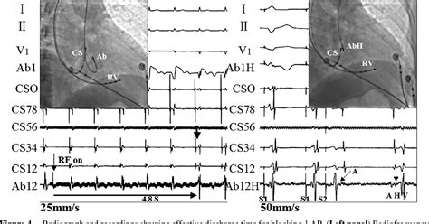 Figure 1 From New Access For Radiofrequency Catheter Ablation Of Left Sided Atrioventricular