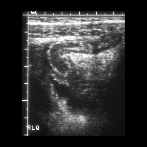 Pediatric Appendicitis Pediatric Radiology Reference Article