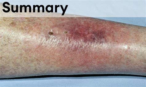 Cellulitis Is An Acute Bacterial Infection Of The Deep Dermis And Surrounding Subcutaneous