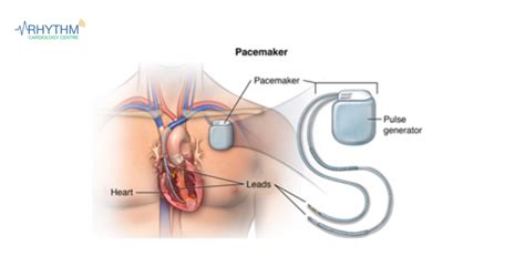 Know Heart Pacemakers And Their Types Heart Surgeon In Indore